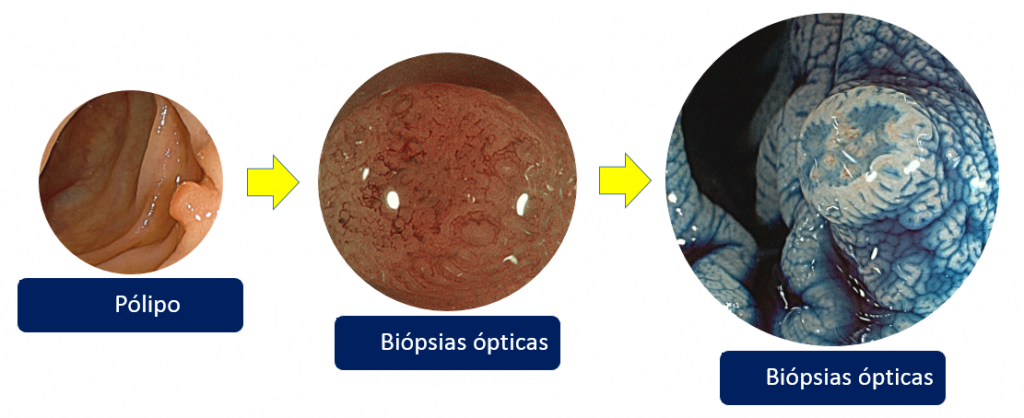 Biópsias Ópticas dos pólipos de intestino durante a Colonoscopia ...
